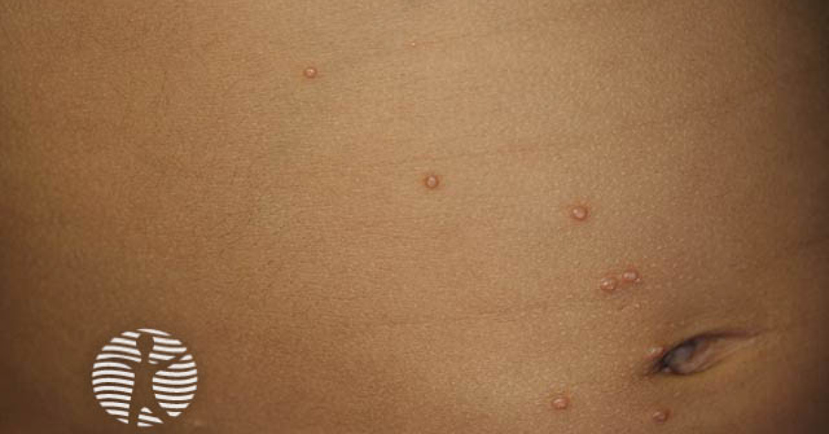 Molluscum contagiosum image