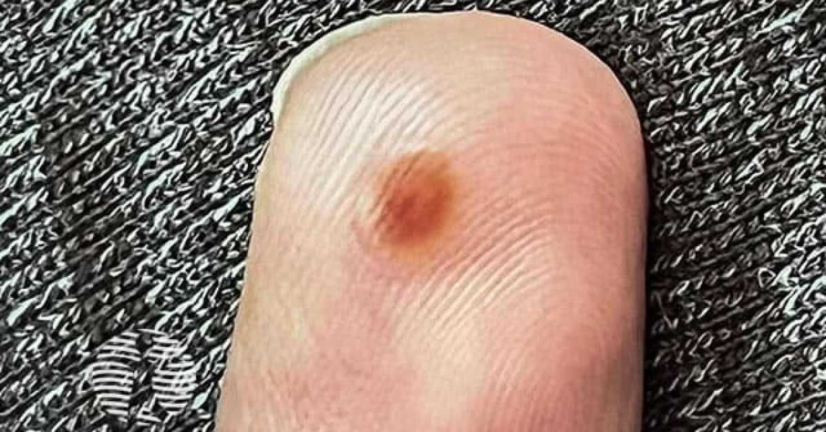 Monkeypox image