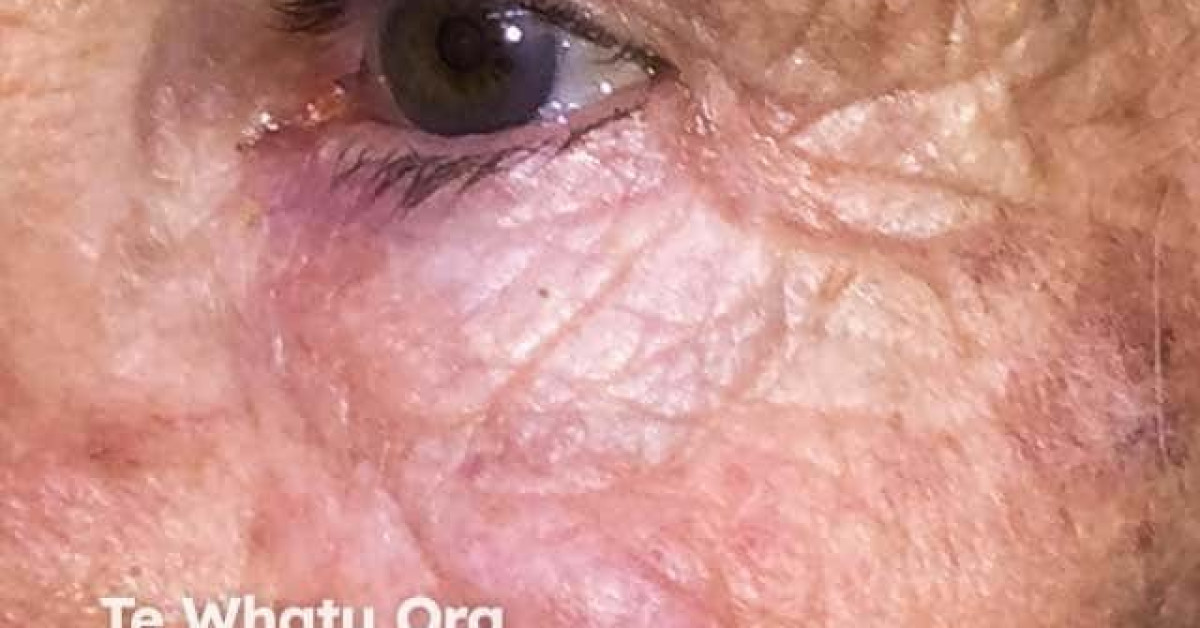 Morbihan disease image