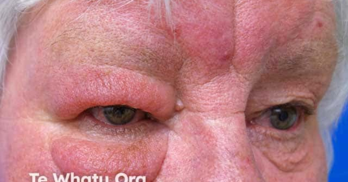 Morbihan disease image