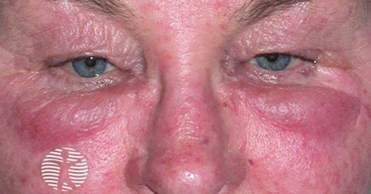 Morbihan disease image