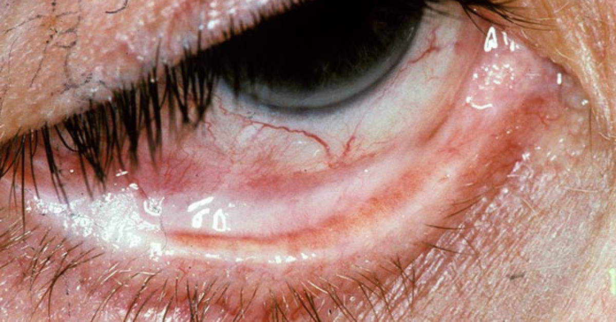 Mucous membrane pemphigoid image