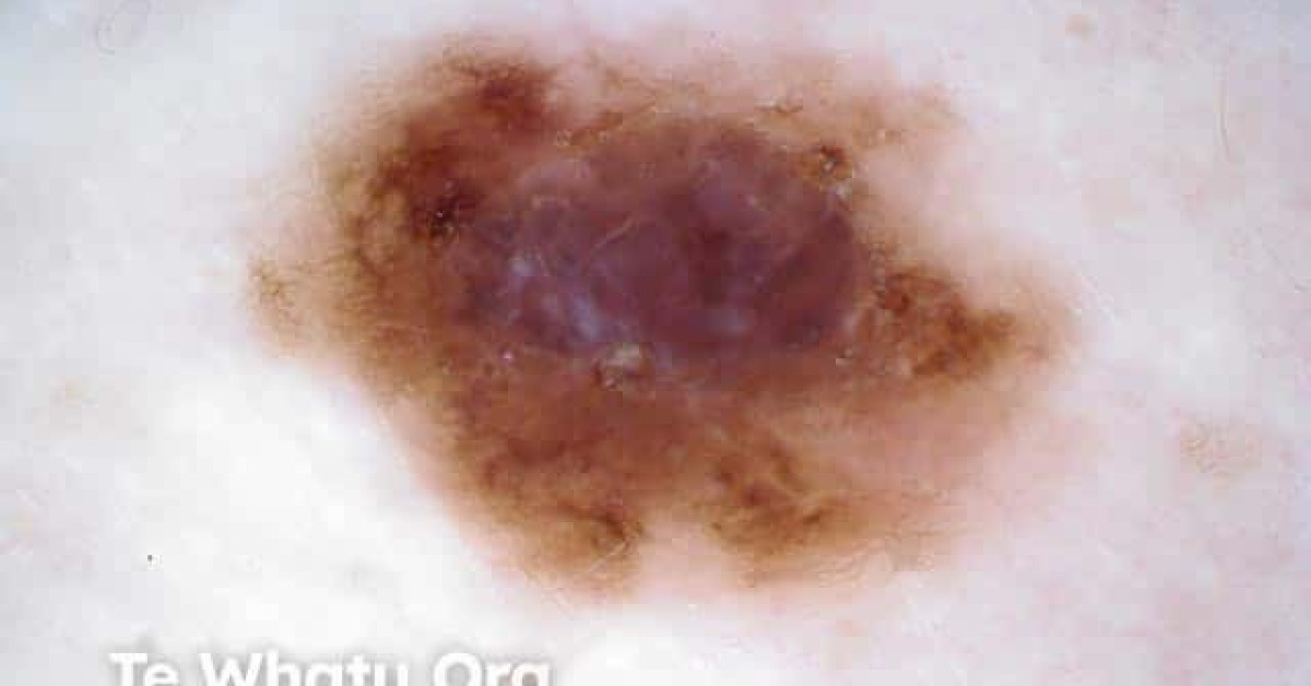 Naevoid melanoma image