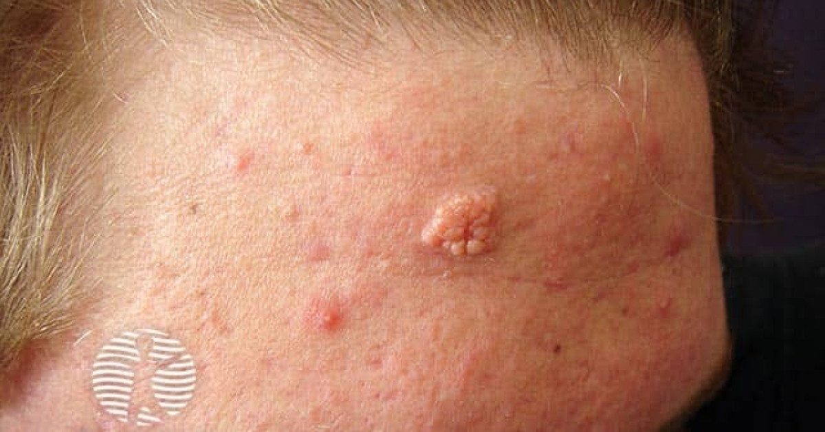 Naevus sebaceous image