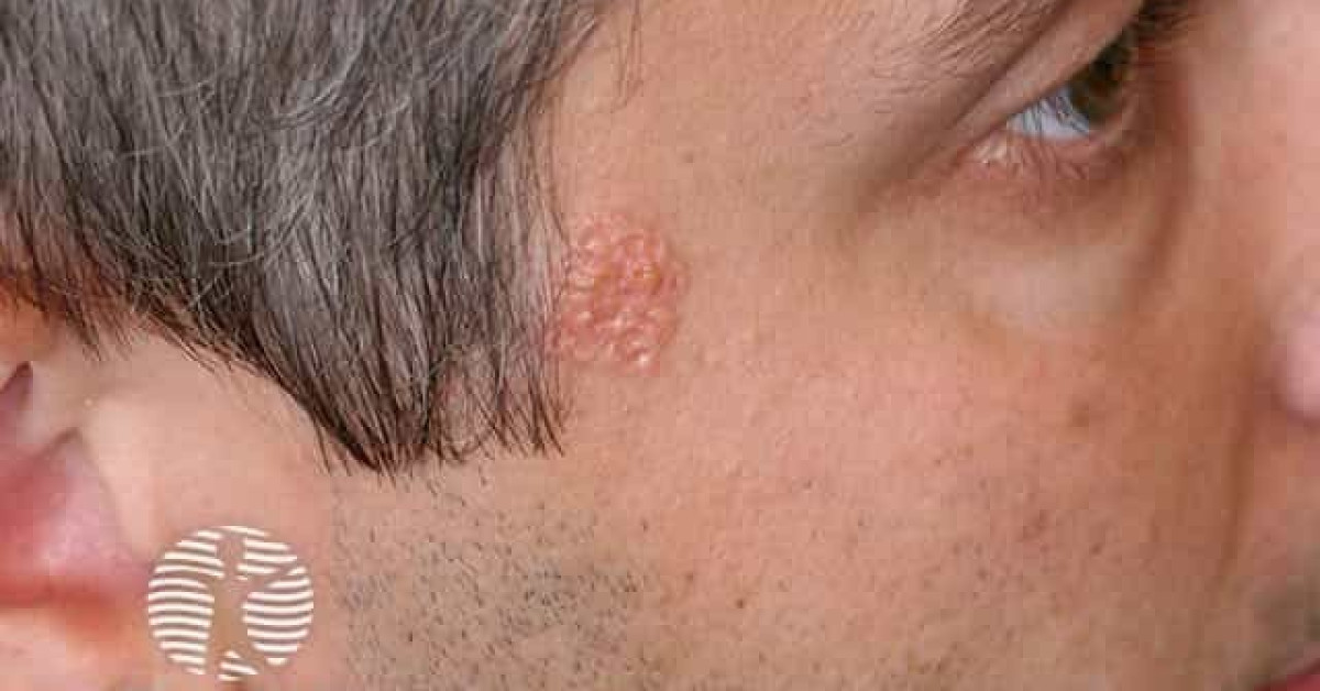 Naevus sebaceous image