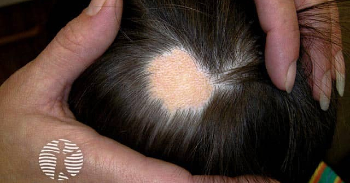 Naevus sebaceous image