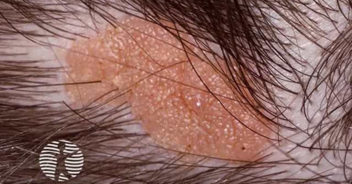 Naevus sebaceous image