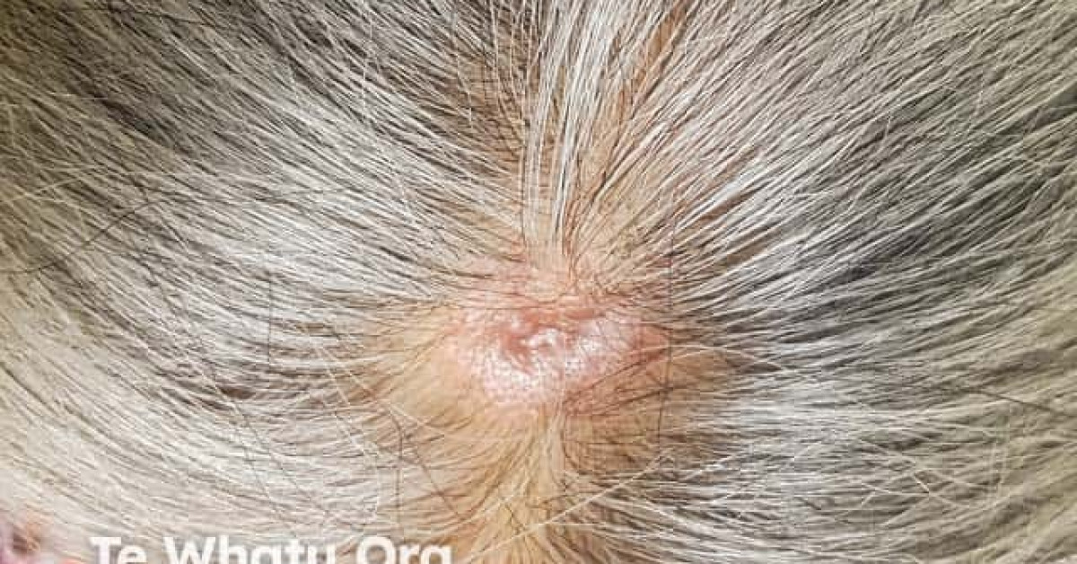 Naevus sebaceous image