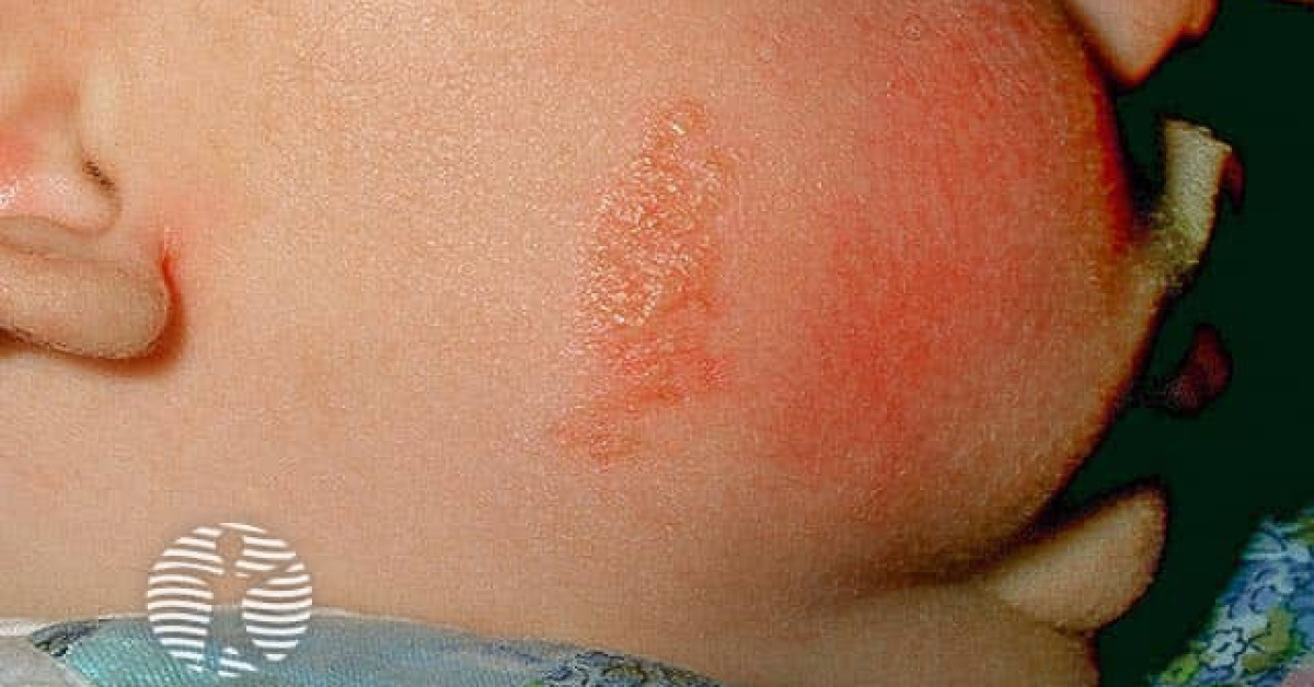 Naevus sebaceous image
