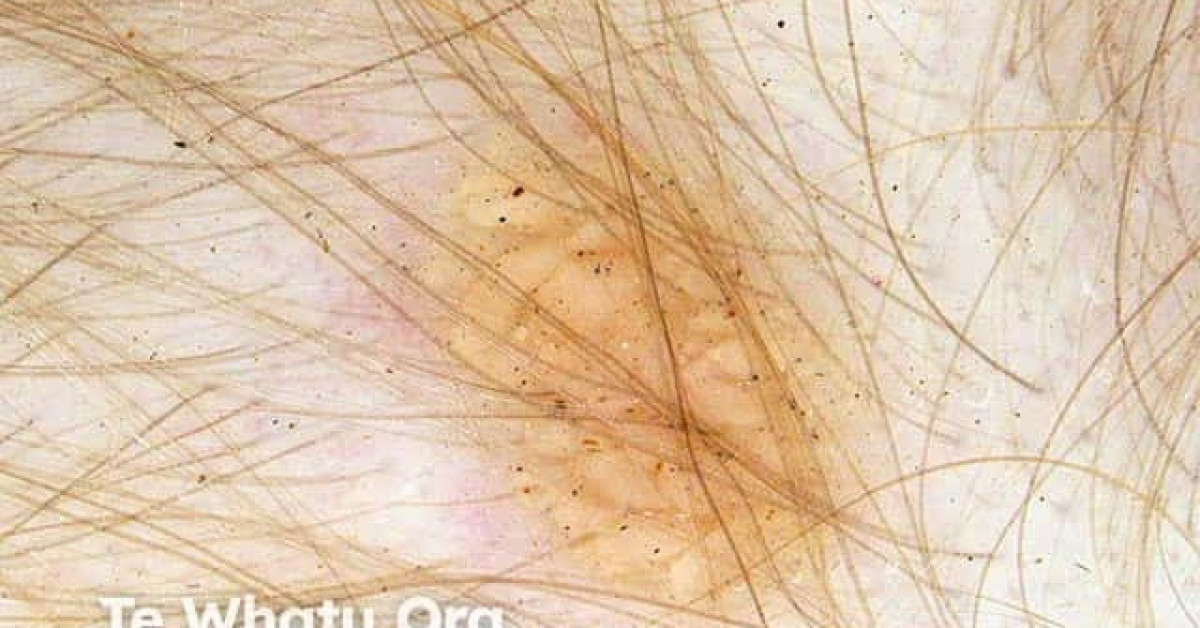 Naevus sebaceous image