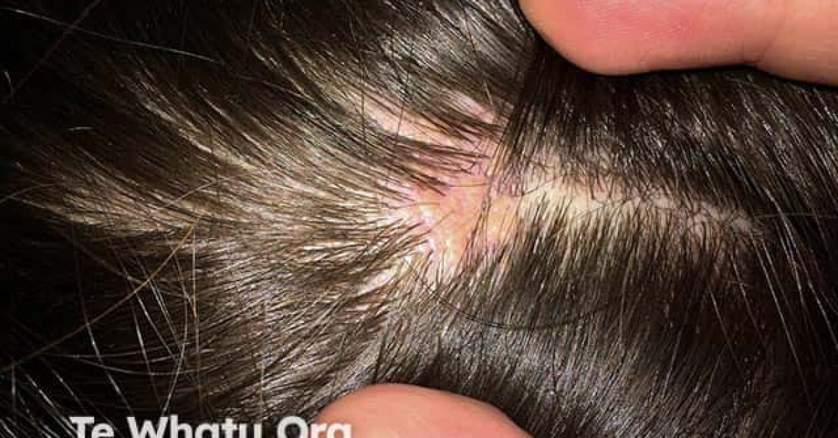 Naevus sebaceous image