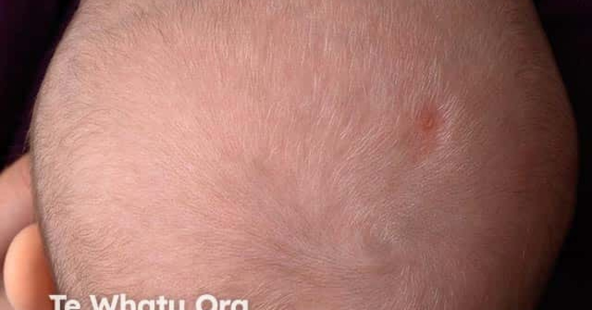 Naevus sebaceous image