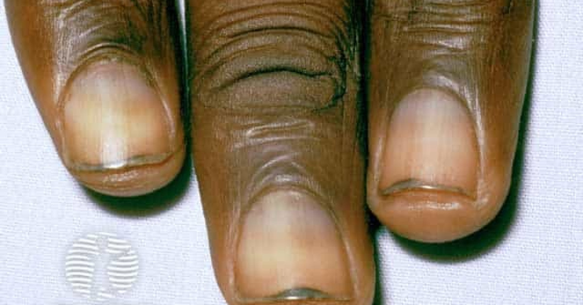 Nail discolouration image