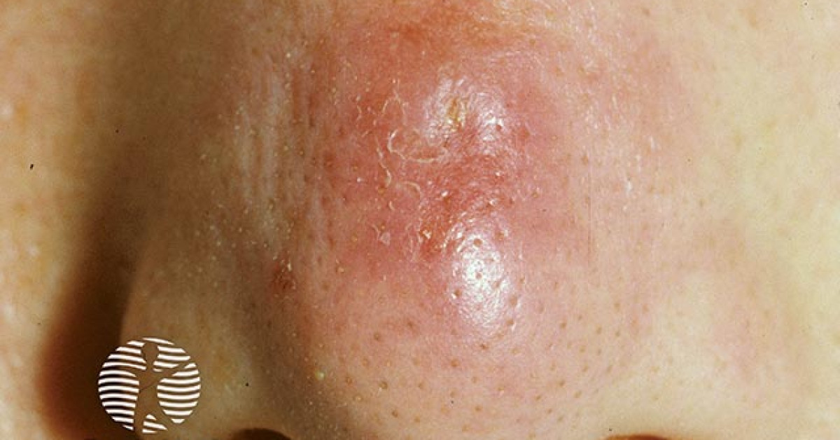 Nasal dermoid fistula image