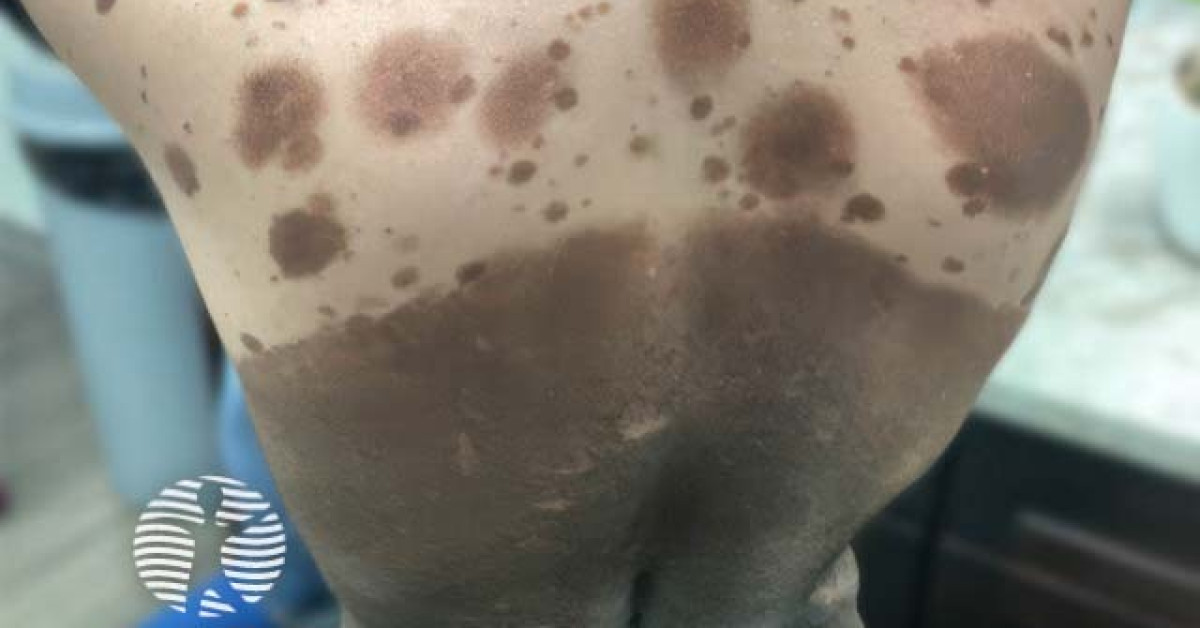 Neurocutaneous melanosis image