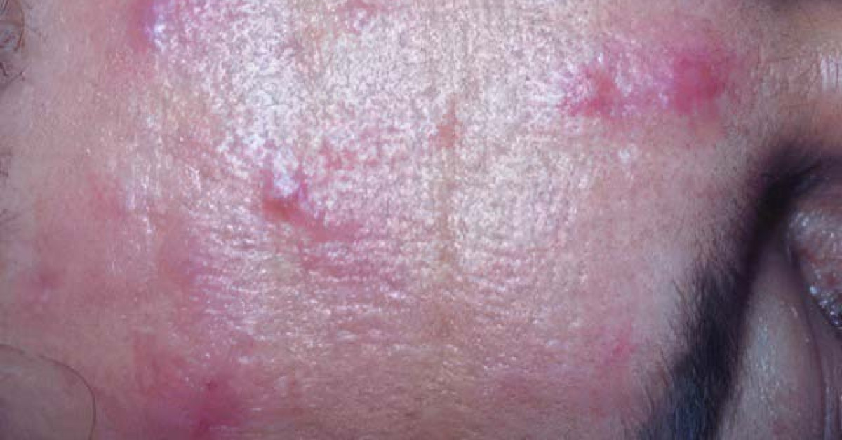 Neutrophilic sebaceous adenitis image