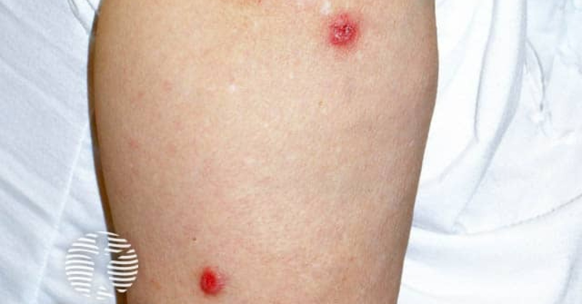 Nodular prurigo image