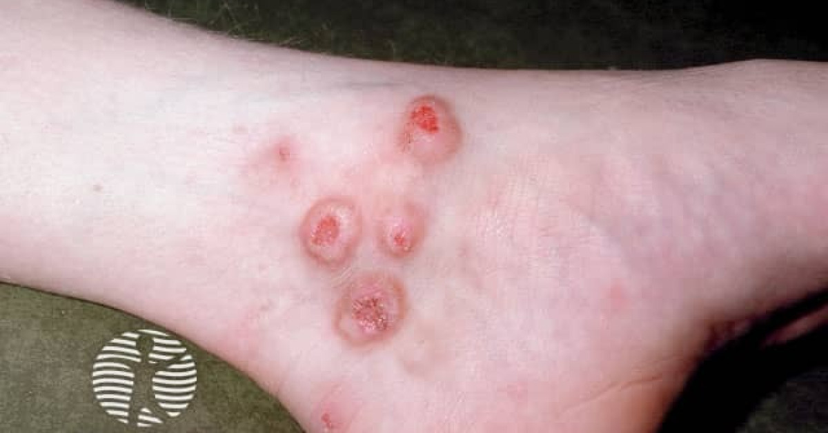 DermNet® - Nodular prurigo image