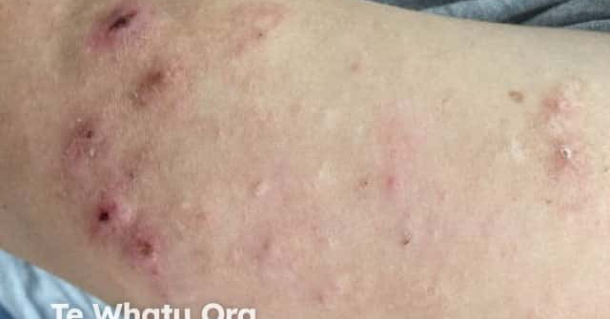 Nodular prurigo image