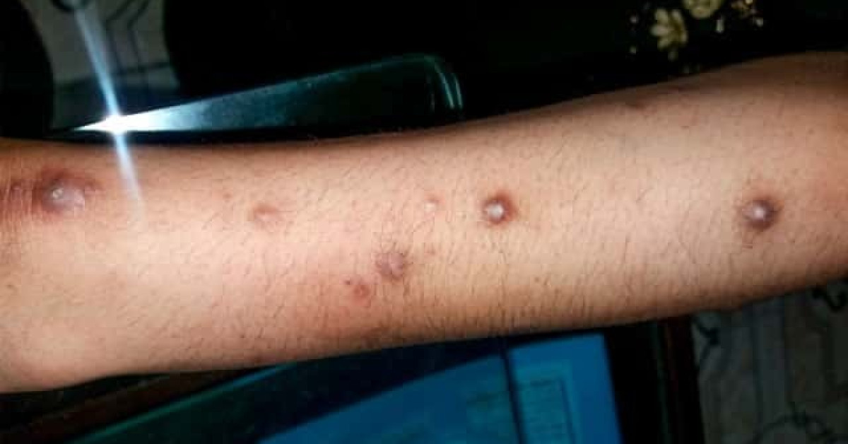 Nodular prurigo image