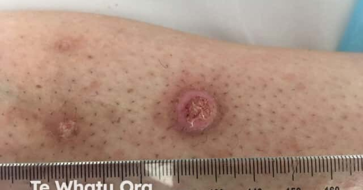 Nodular prurigo image