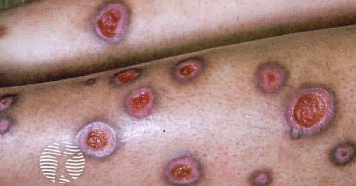 Nodular prurigo image