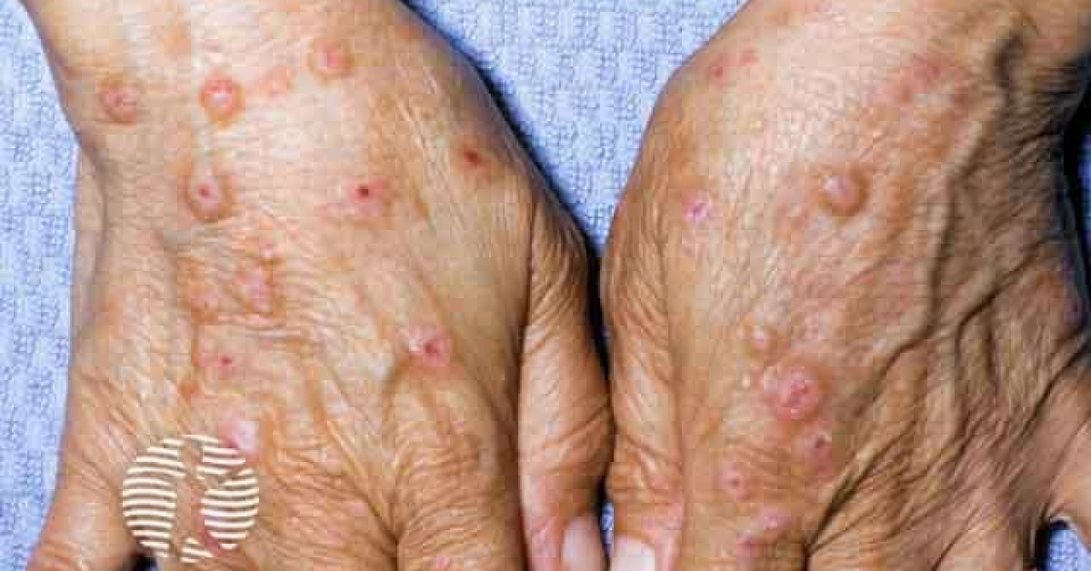 Nodular prurigo image