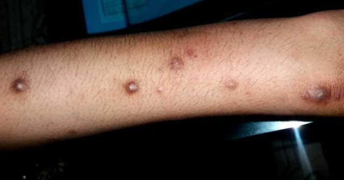 Nodular prurigo image