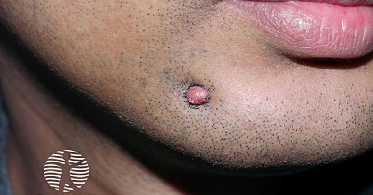 Odontogenic cutaneous sinus tract image