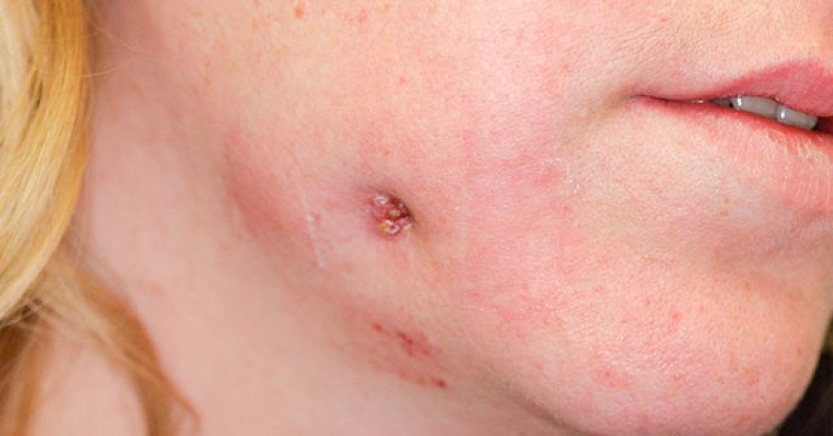 Odontogenic cutaneous sinus tract image