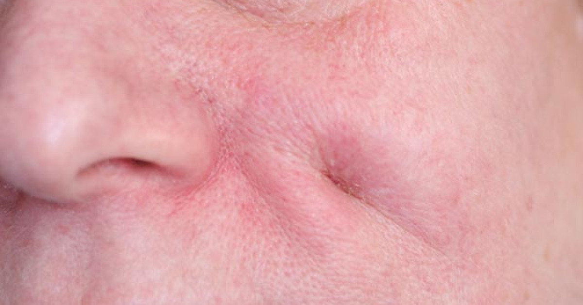 Odontogenic cutaneous sinus tract image
