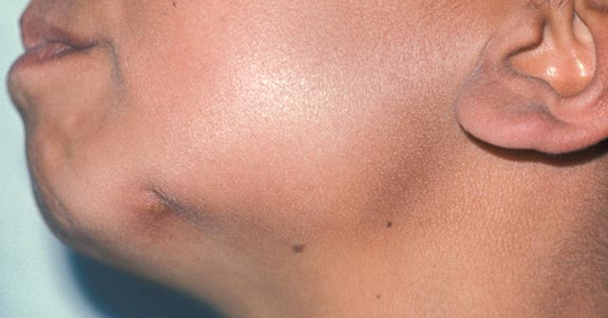 Odontogenic cutaneous sinus tract image