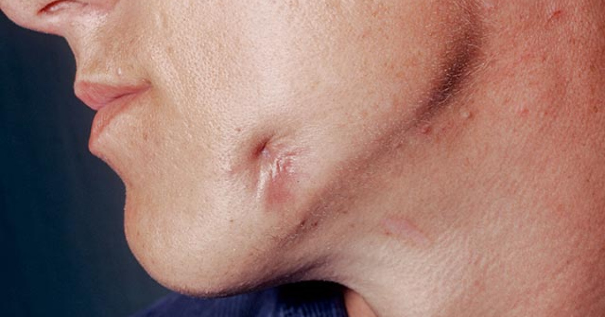 Odontogenic cutaneous sinus tract image