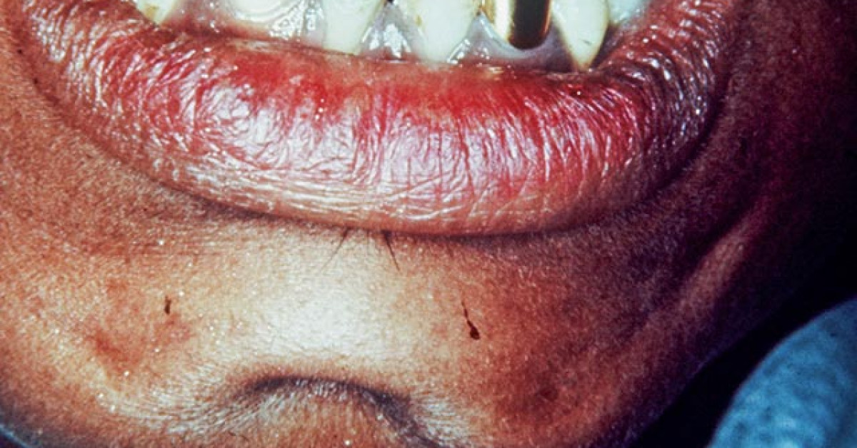 Odontogenic cutaneous sinus tract image