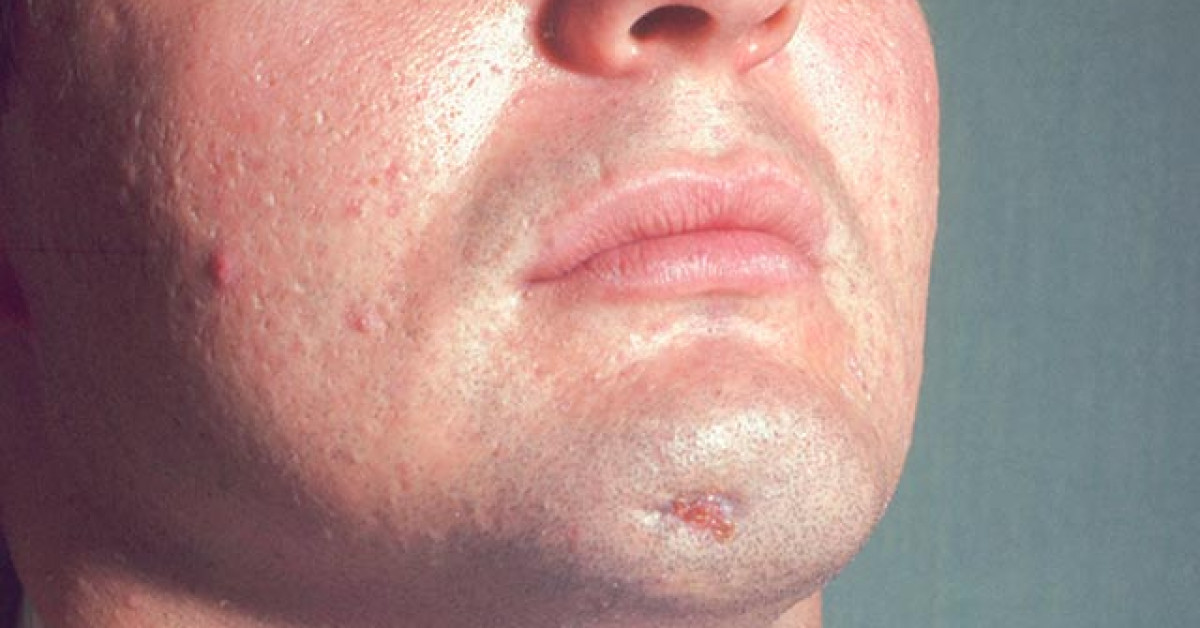 Odontogenic cutaneous sinus tract image