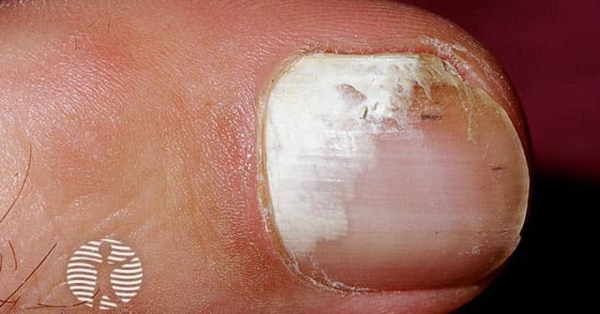 Onychomycosis image