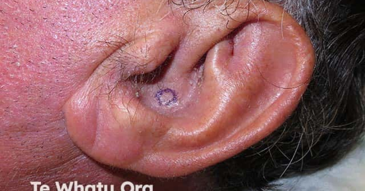 Otitis externa image