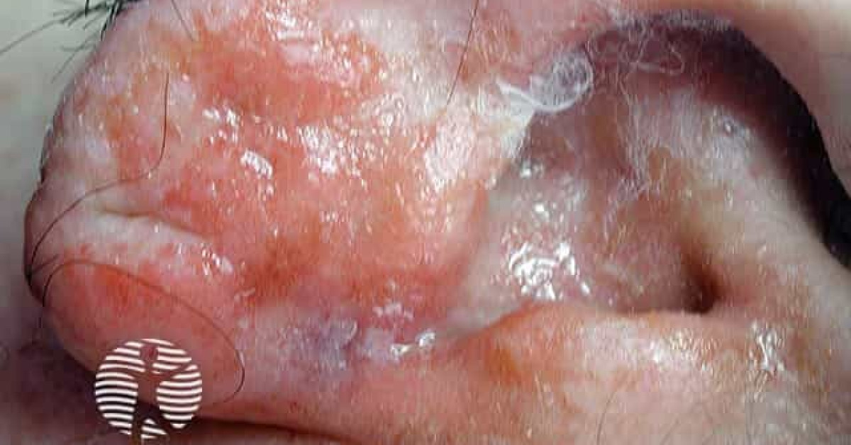 Otitis externa image