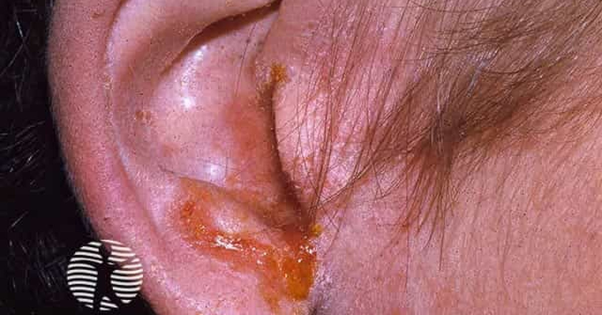 Otitis externa image