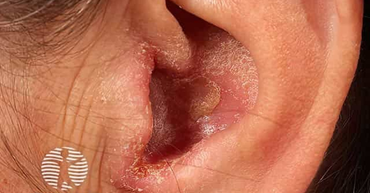 Otitis externa image