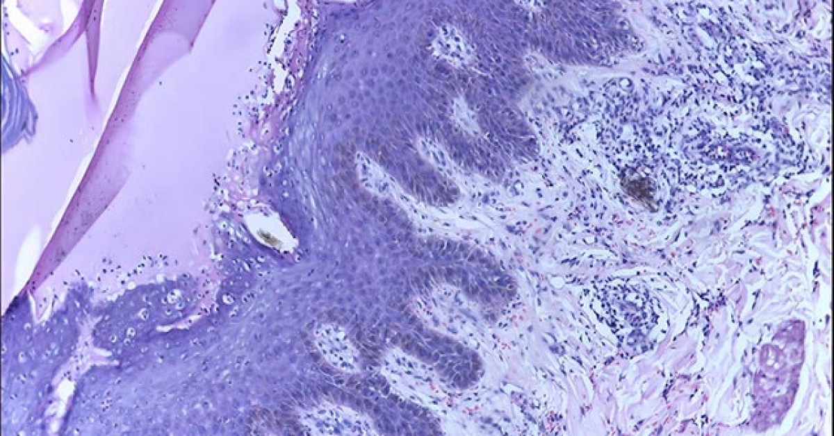 PLACK syndrome histopathology image