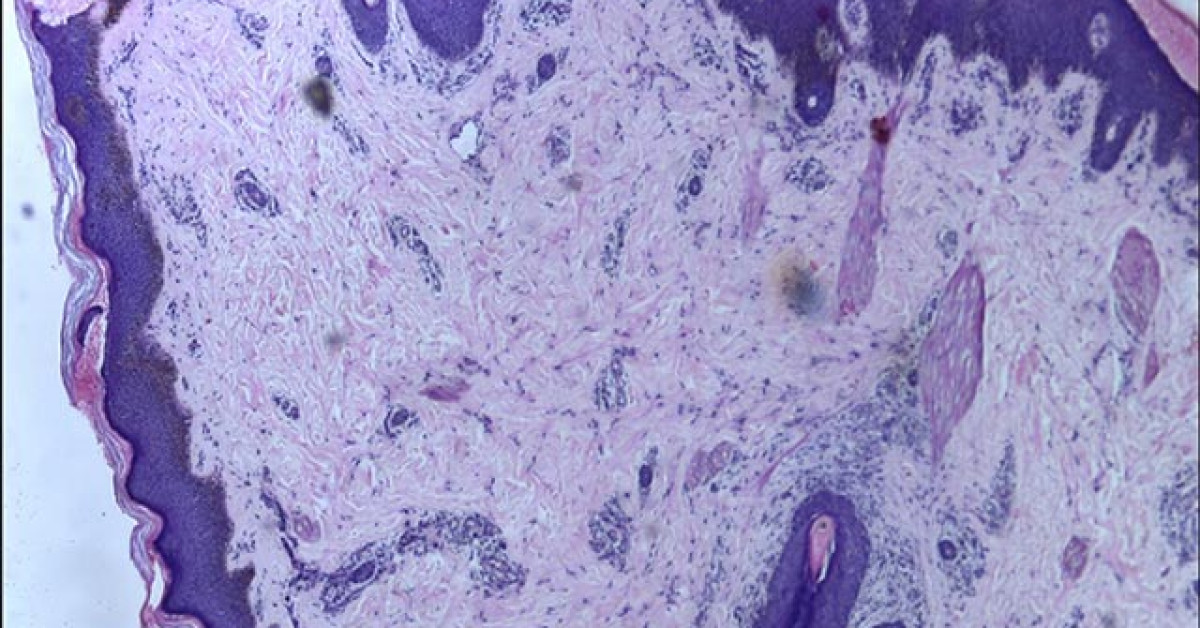 PLACK syndrome histopathology image
