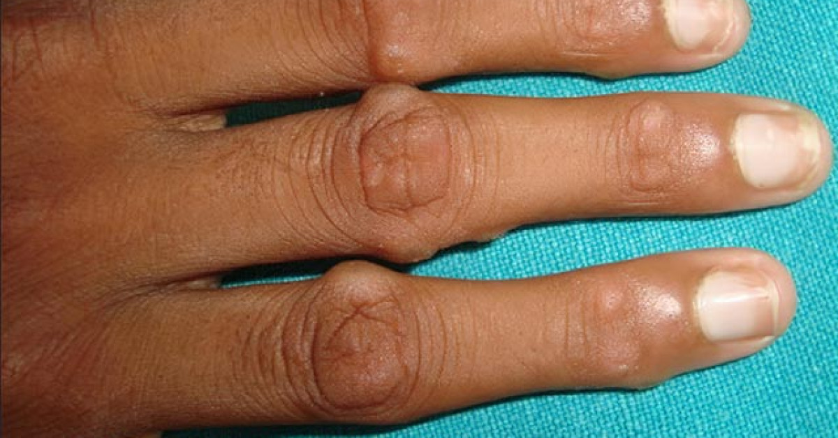 PLACK syndrome image