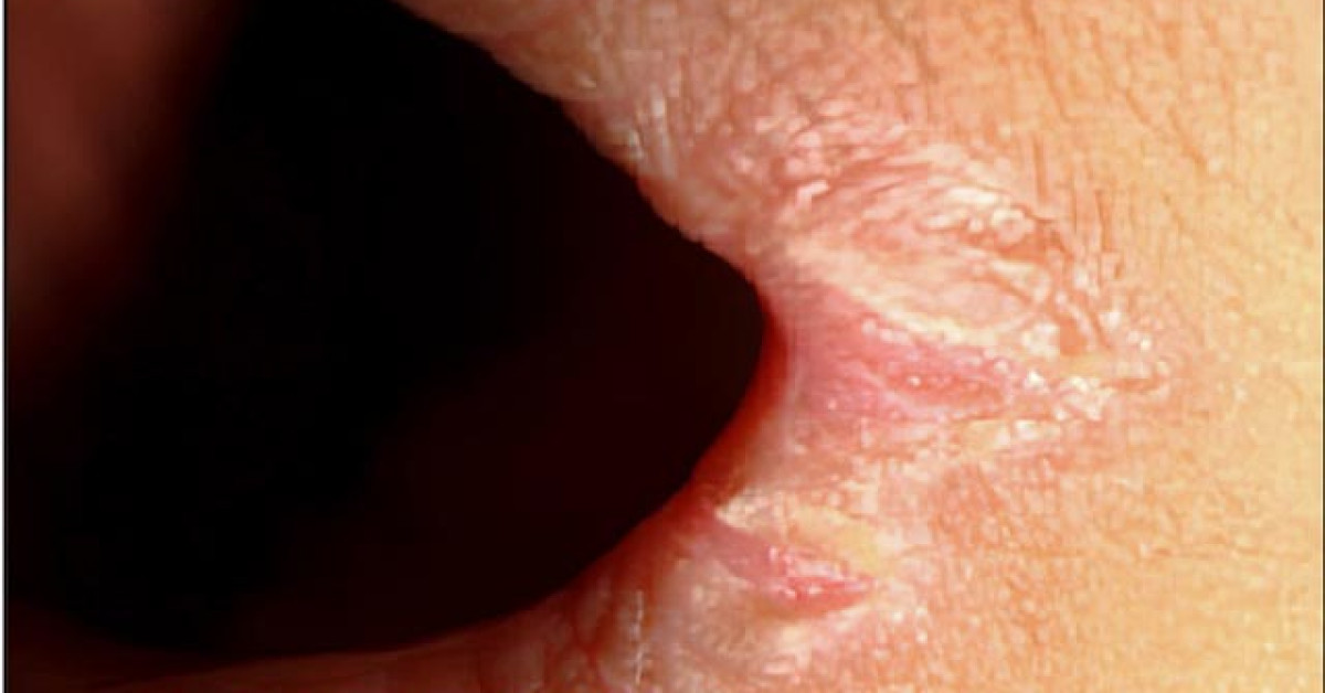 PLACK syndrome image