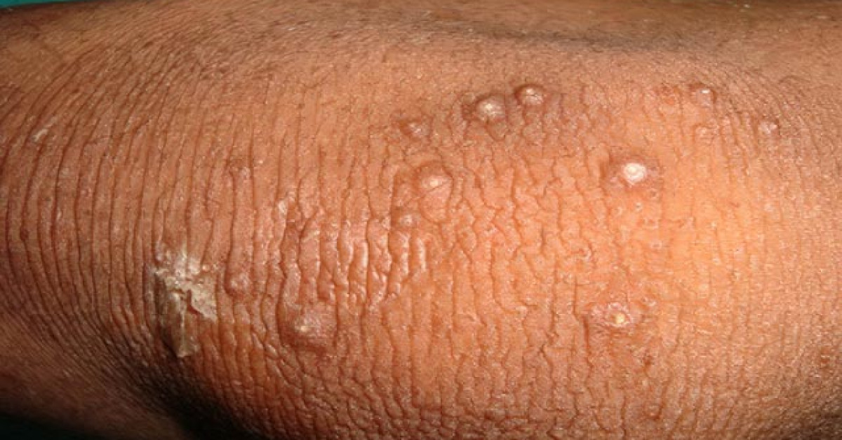 PLACK syndrome image