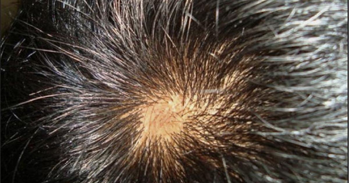 PLACK syndrome image