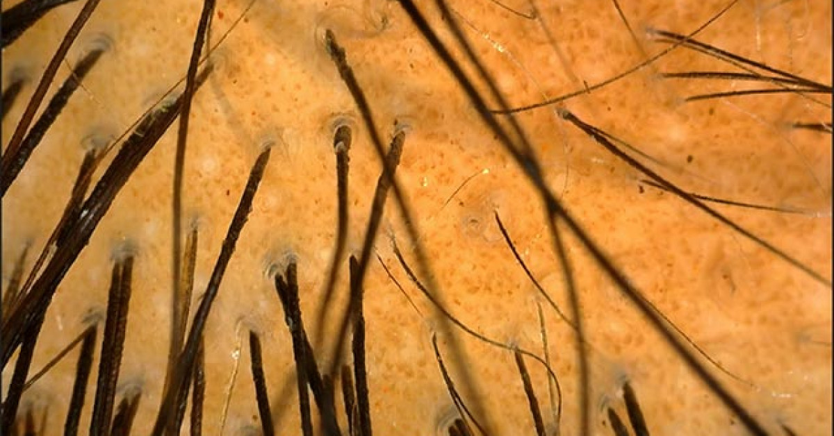 PLACK syndrome image