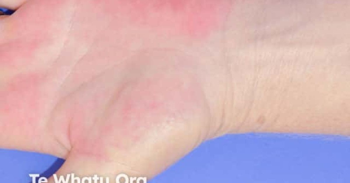 Palmar erythema image