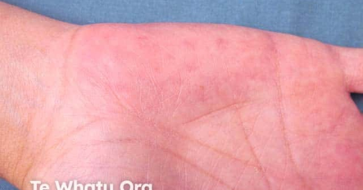 Palmar erythema image