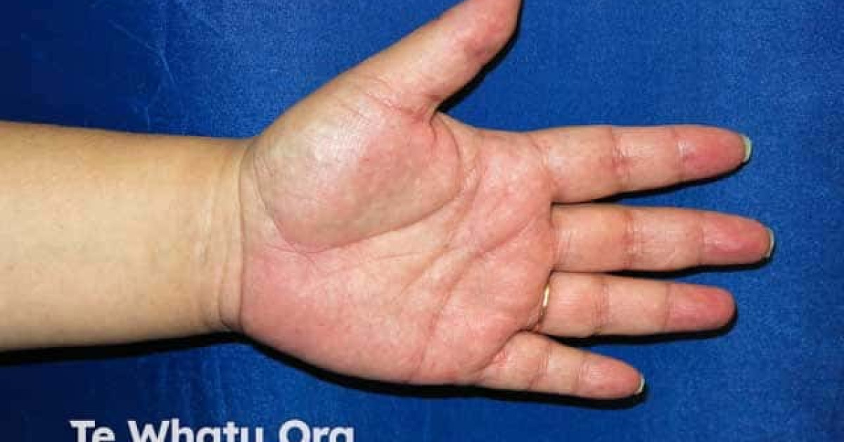 Palmar erythema image